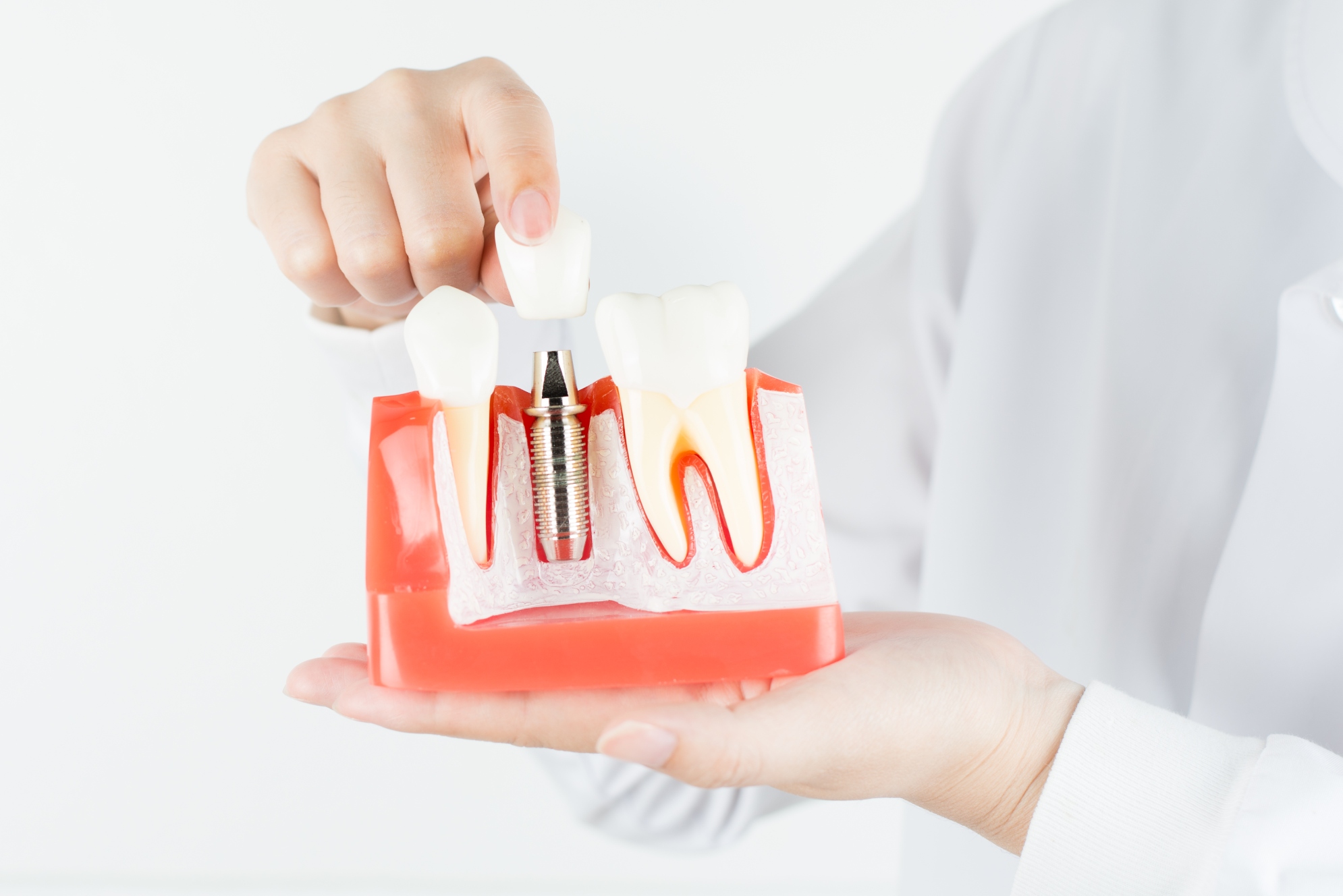 Root Canal Treatment | Best Dental Hospital in Hyderabad